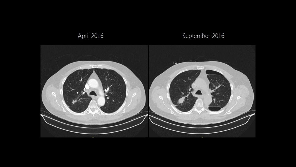 Single Incision Vats Right Upper Lobe Posterior Segmentectomy Ctsnet